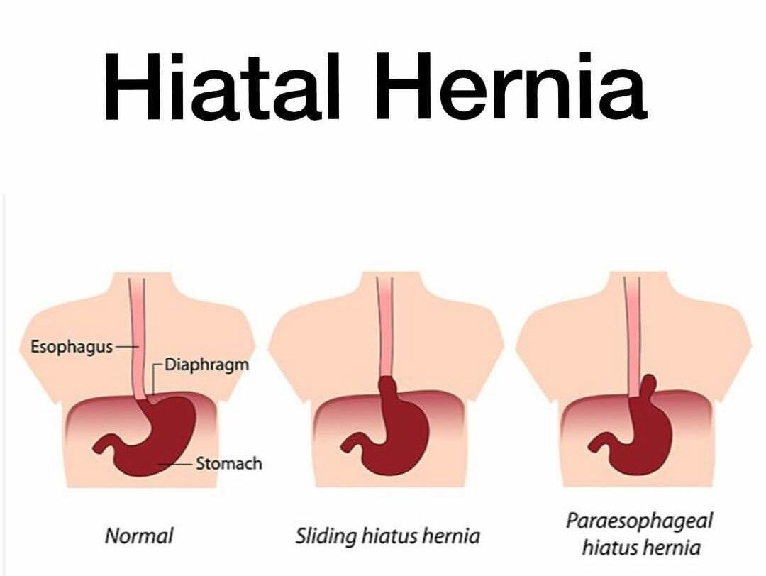 Paraesophageal Hernia