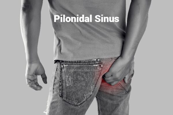 Pilonidal Sinus Infection And Surgical Treatment | Dr.Abhijit Gotkhinde