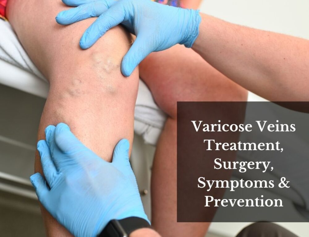 Varicose Veins and Spider Veins: Causes and Treatments