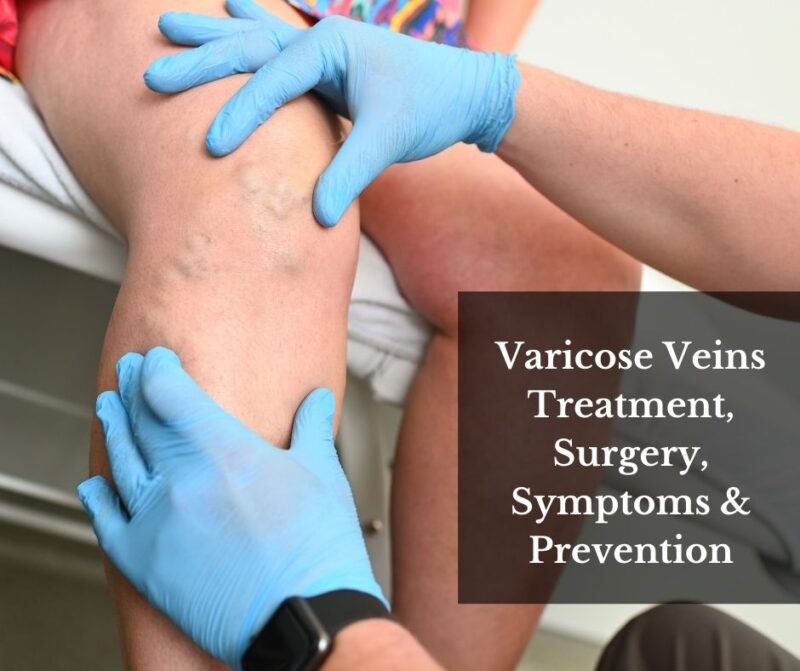 Varicose Veins Treatment, Surgery, Symptoms & Prevention